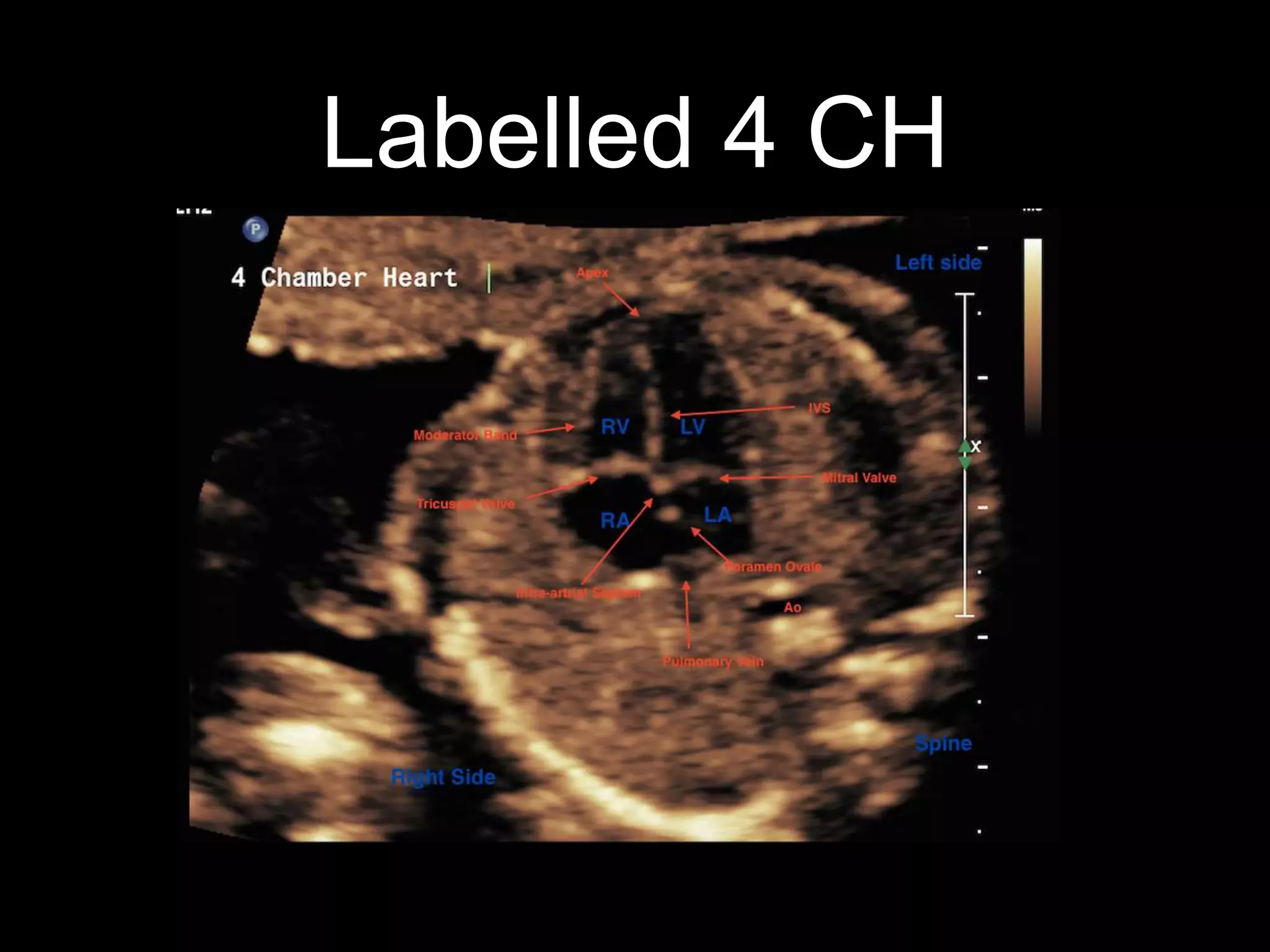 Labelled fetal heart ultrasound | PPTX