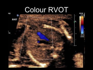Labelled fetal heart ultrasound | PPTX