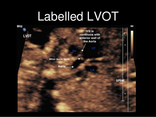 Labelled fetal heart ultrasound