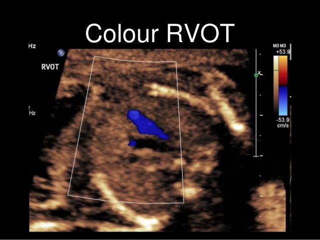Labelled fetal heart ultrasound