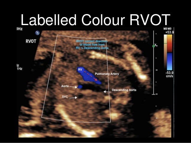 Labelled fetal heart ultrasound