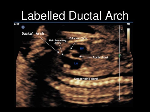 Labelled fetal heart ultrasound