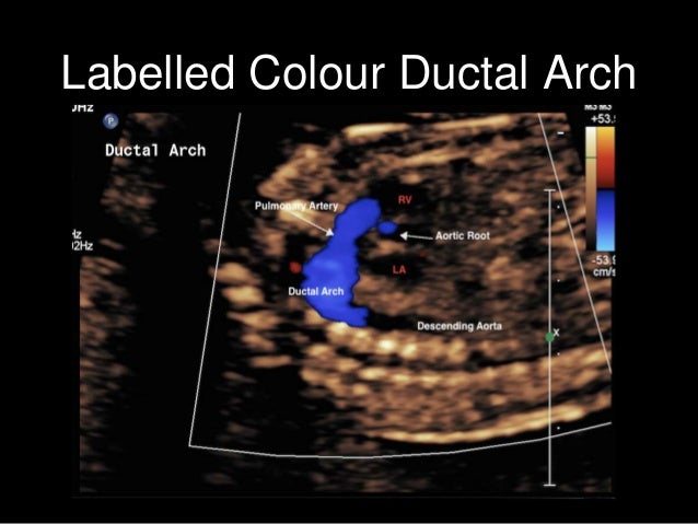 Labelled fetal heart ultrasound