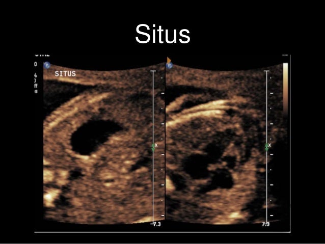 Labelled fetal heart ultrasound