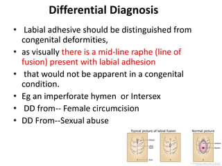 Labial adhesion | PPTX