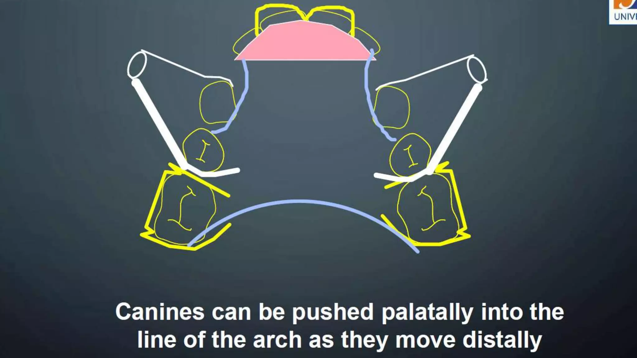 Labial bow Functions , Constructions , Types & Indications. | PPTX