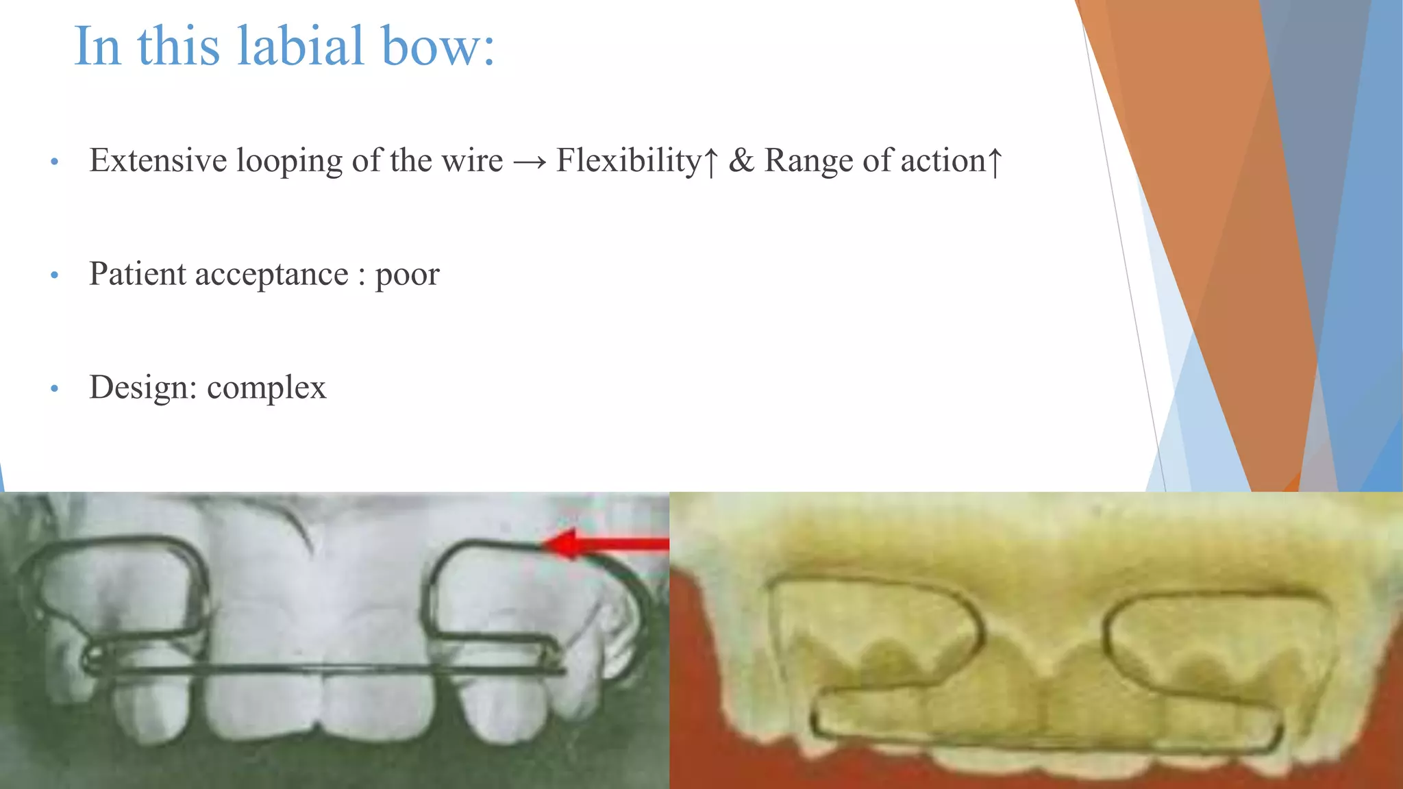 Labial bow Functions , Constructions , Types & Indications. | PPTX