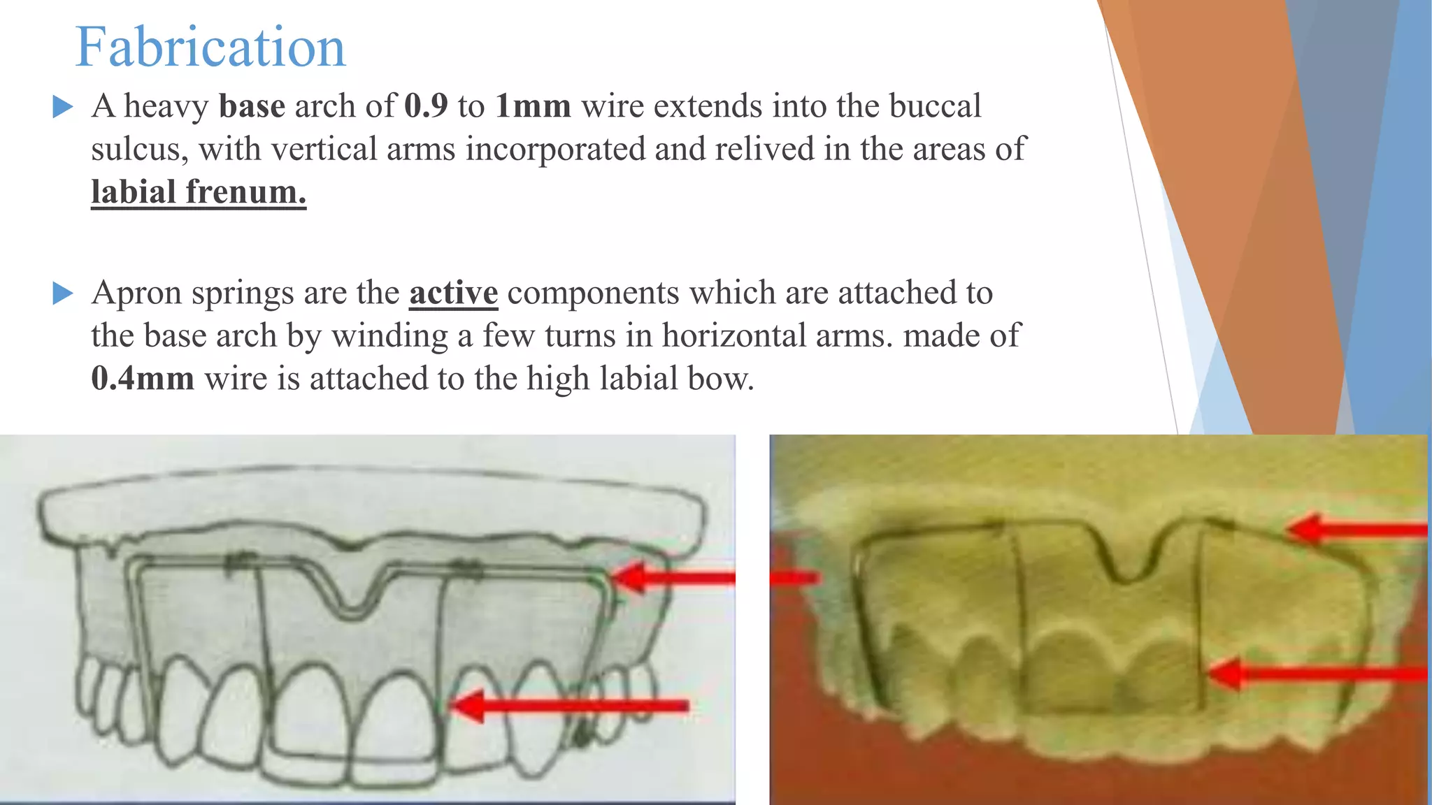 Labial bow Functions , Constructions , Types & Indications. | PPTX