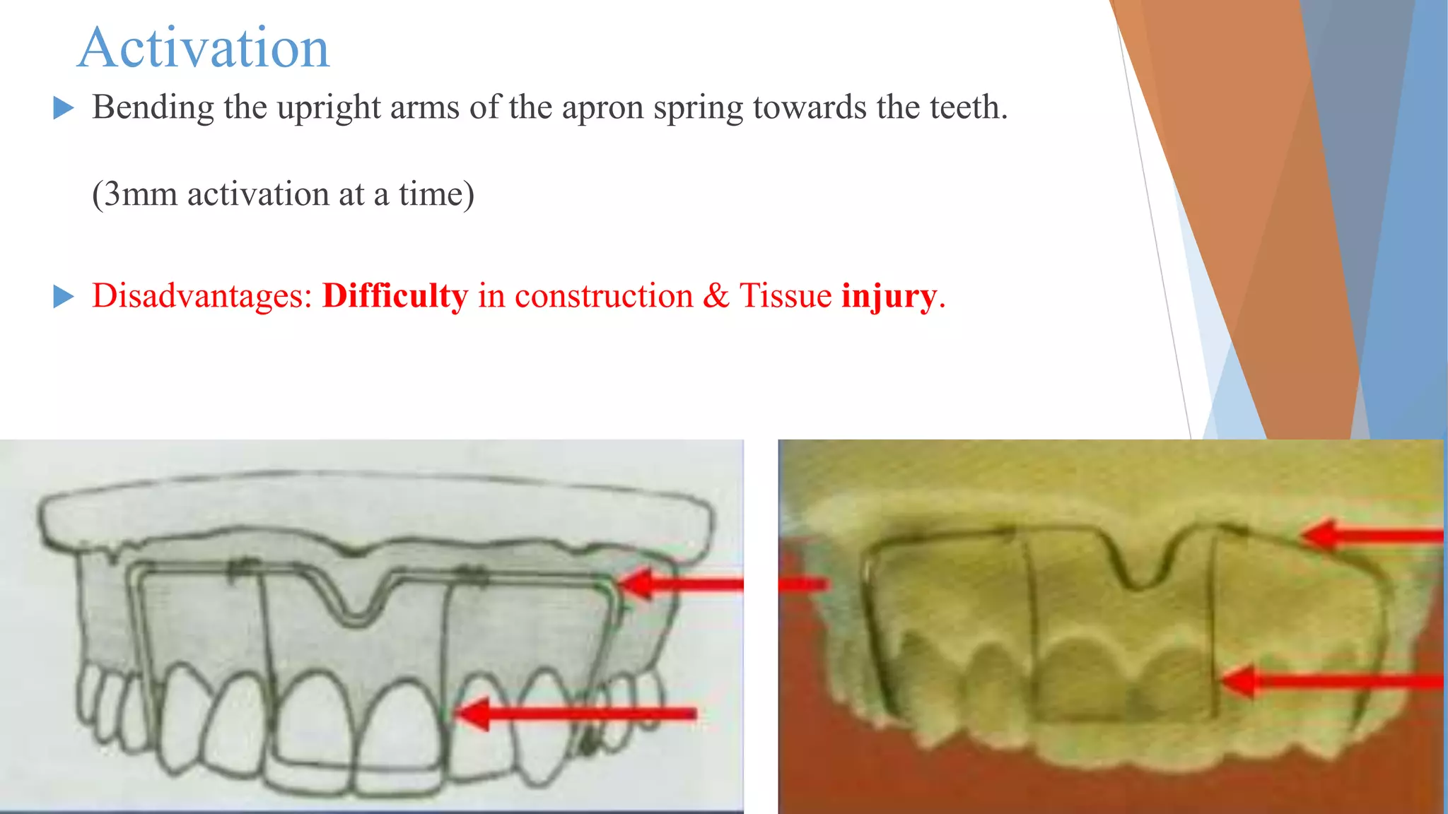 Labial bow Functions , Constructions , Types & Indications. | PPTX