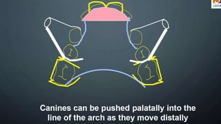 Labial bow Functions , Constructions , Types & Indications. | PPTX