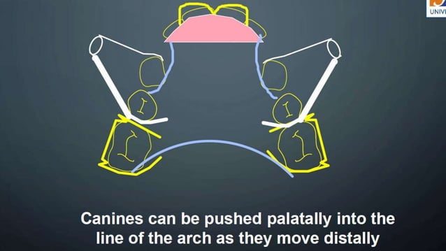 Labial bow Functions , Constructions , Types & Indications. | PPTX ...