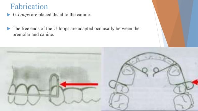 Labial bow Functions , Constructions , Types & Indications. | PPTX ...
