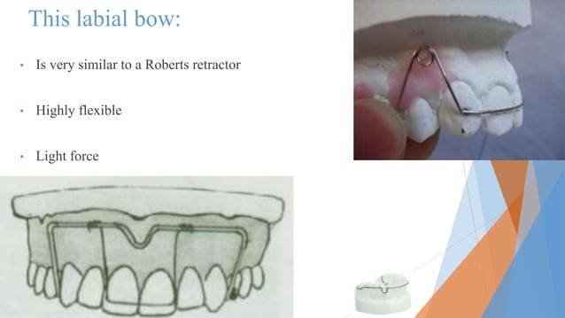 Labial bow Functions , Constructions , Types & Indications. | PPTX ...
