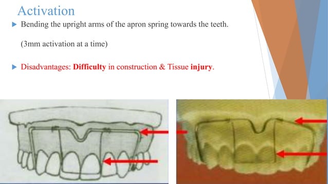 Labial bow Functions , Constructions , Types & Indications. | PPTX ...