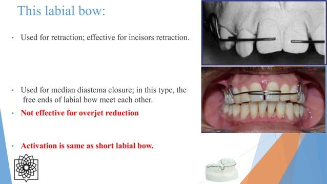 Labial bow Functions , Constructions , Types & Indications. | PPTX ...
