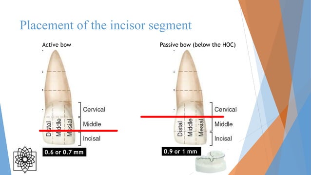 Labial bow Functions , Constructions , Types & Indications. | PPTX ...