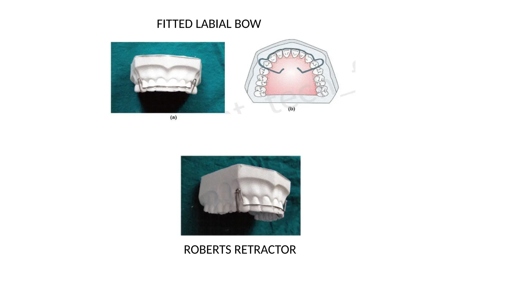 LABIAL BOW.pptx orthodontics required for bds | PPTX