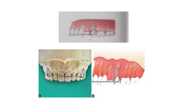 LABIAL BOW.pptx orthodontics required for bds | PPTX