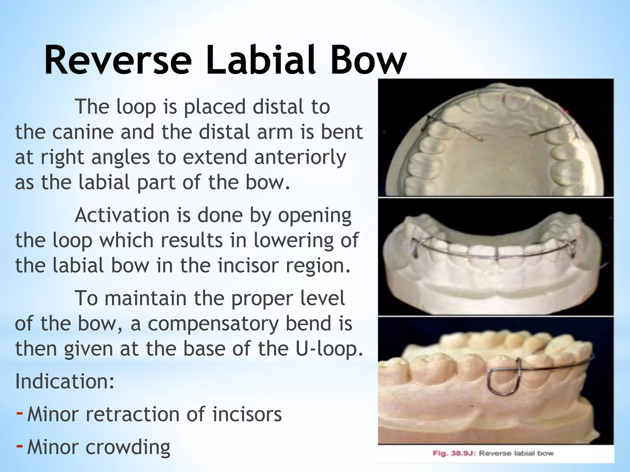 Labial bows | PPTX