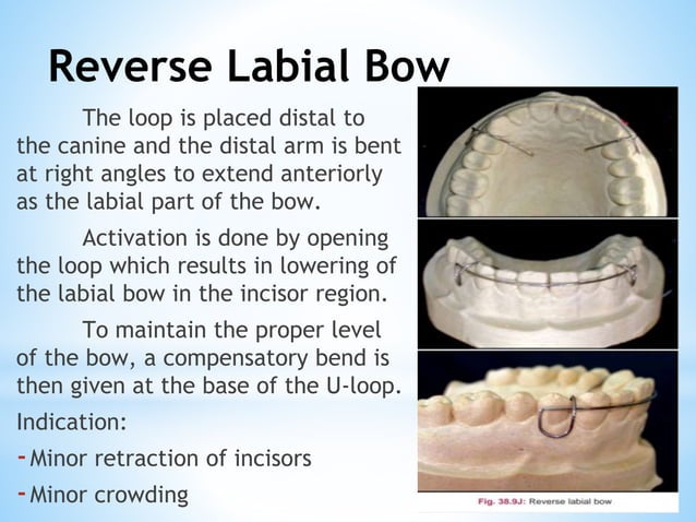 Labial bows | PPTX | Dental Health | Diseases and Conditions