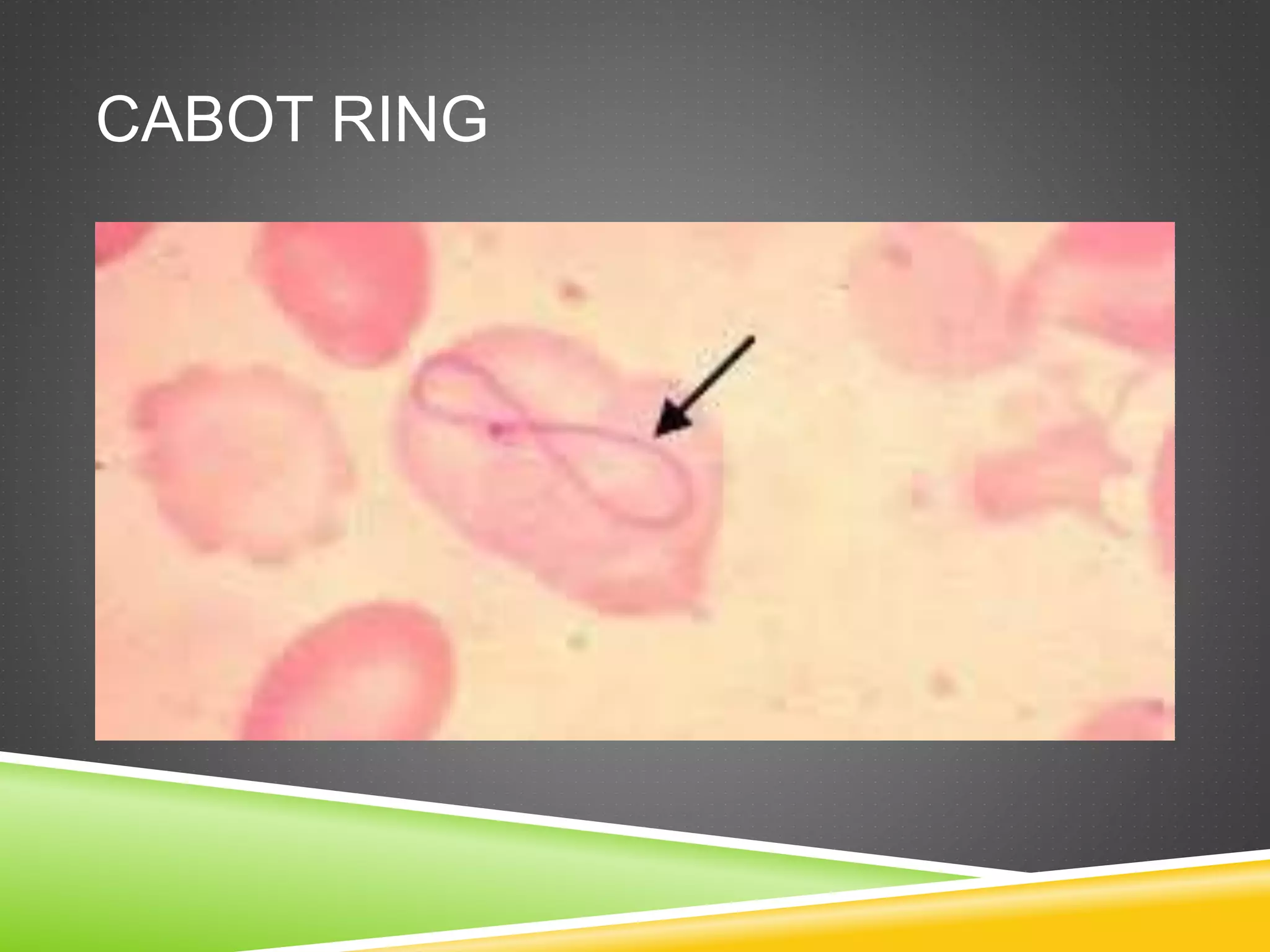 Lab investigations of megaloblastic anaemia | PPTX
