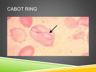 Lab investigations of megaloblastic anaemia | PPT
