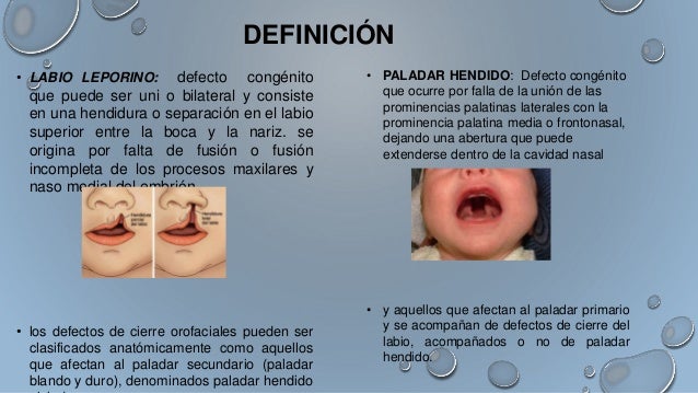 Labio leporino-y-paladar-hendido