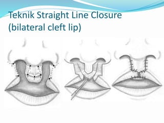 Labiochisis_PPT 2.ppt