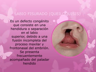 Labio fisurado | PPTX