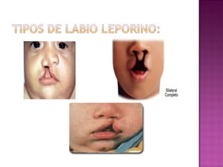 Labio leporino | PPT | Ear, Nose and Throat Conditions | Diseases and ...