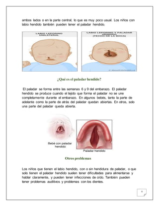 Labio leporino.docx