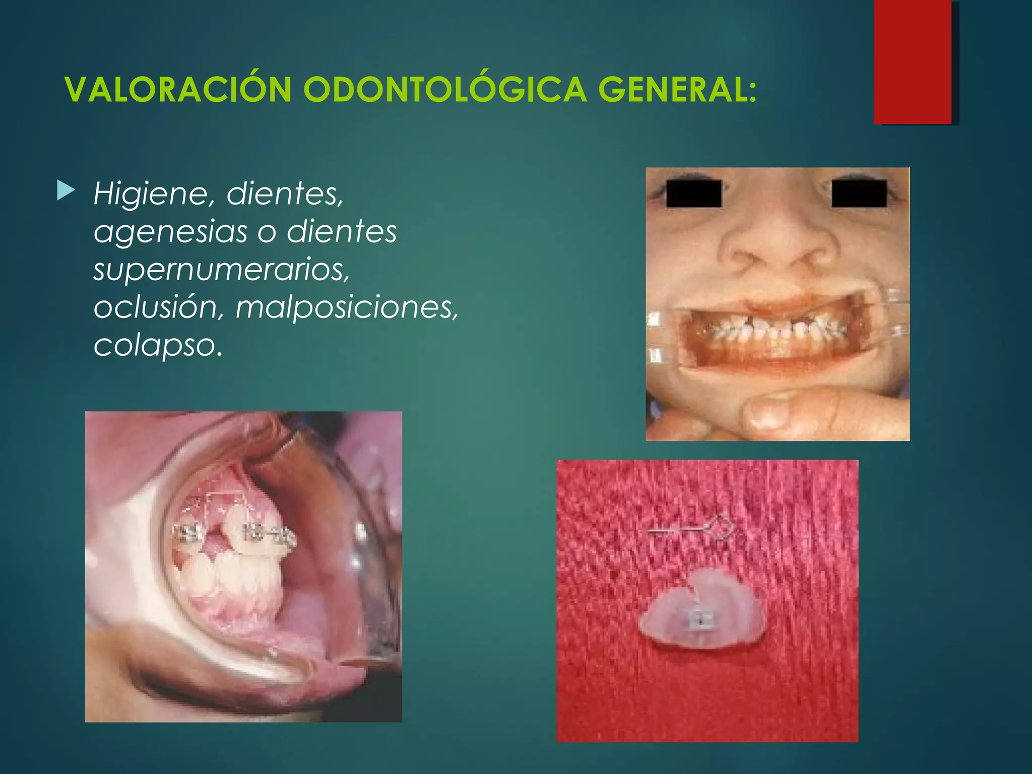 LABIO LEPORINO, FISURA DE PALADAR, TRATAMIENTO PRIMARIO | PPT