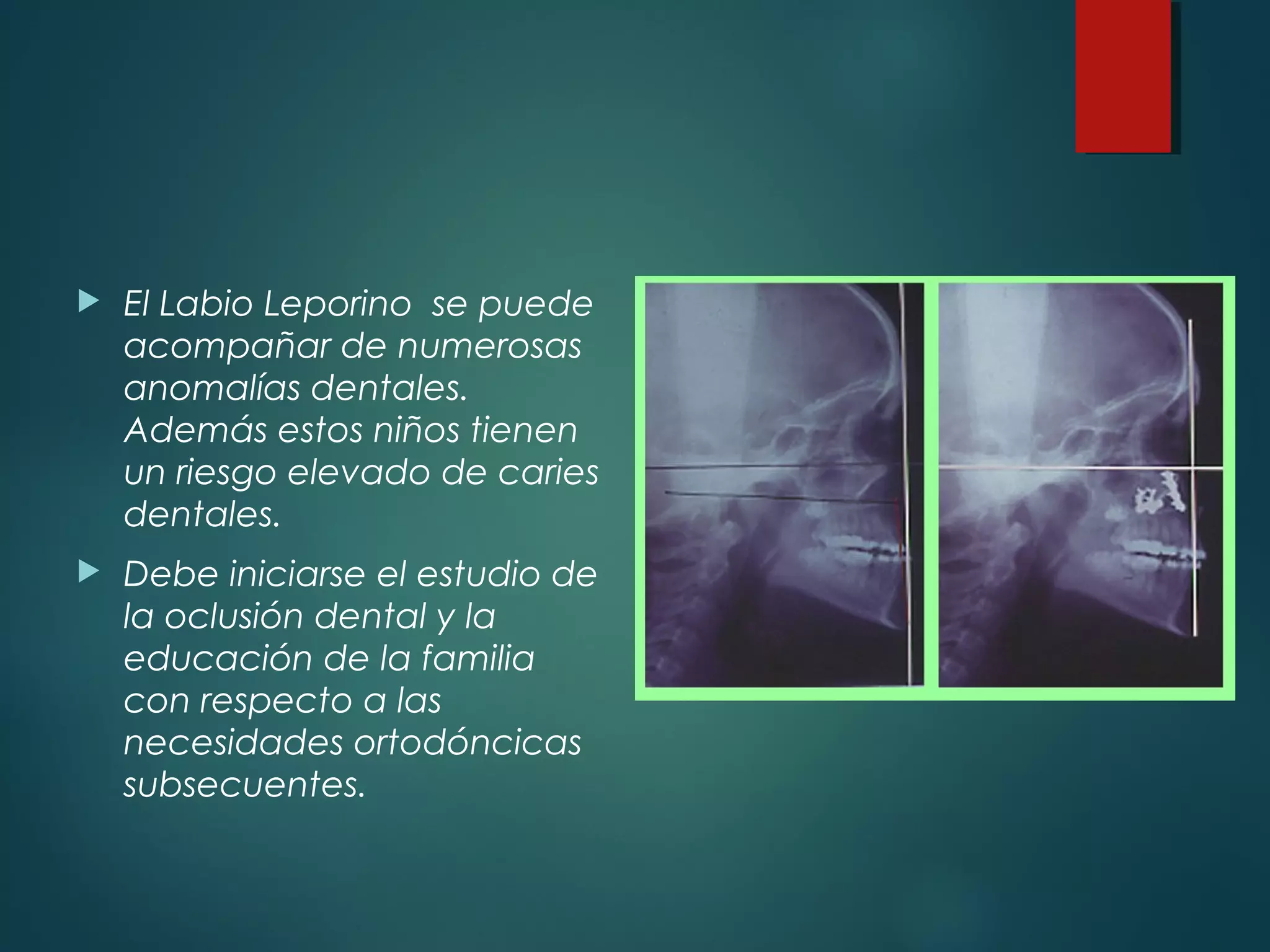 LABIO LEPORINO, FISURA DE PALADAR, TRATAMIENTO PRIMARIO | PPT