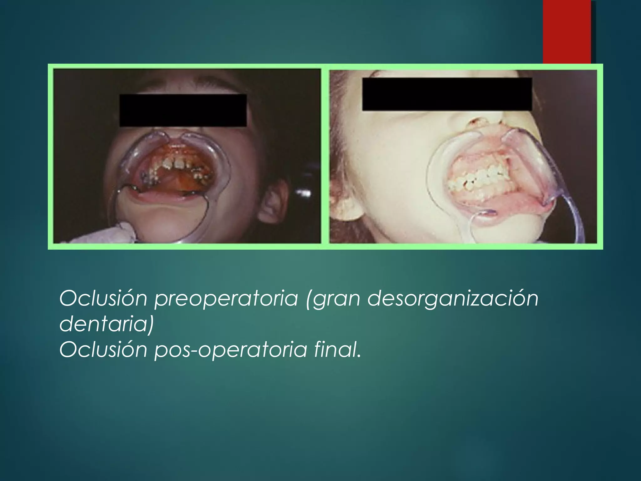 LABIO LEPORINO, FISURA DE PALADAR, TRATAMIENTO PRIMARIO | PPT