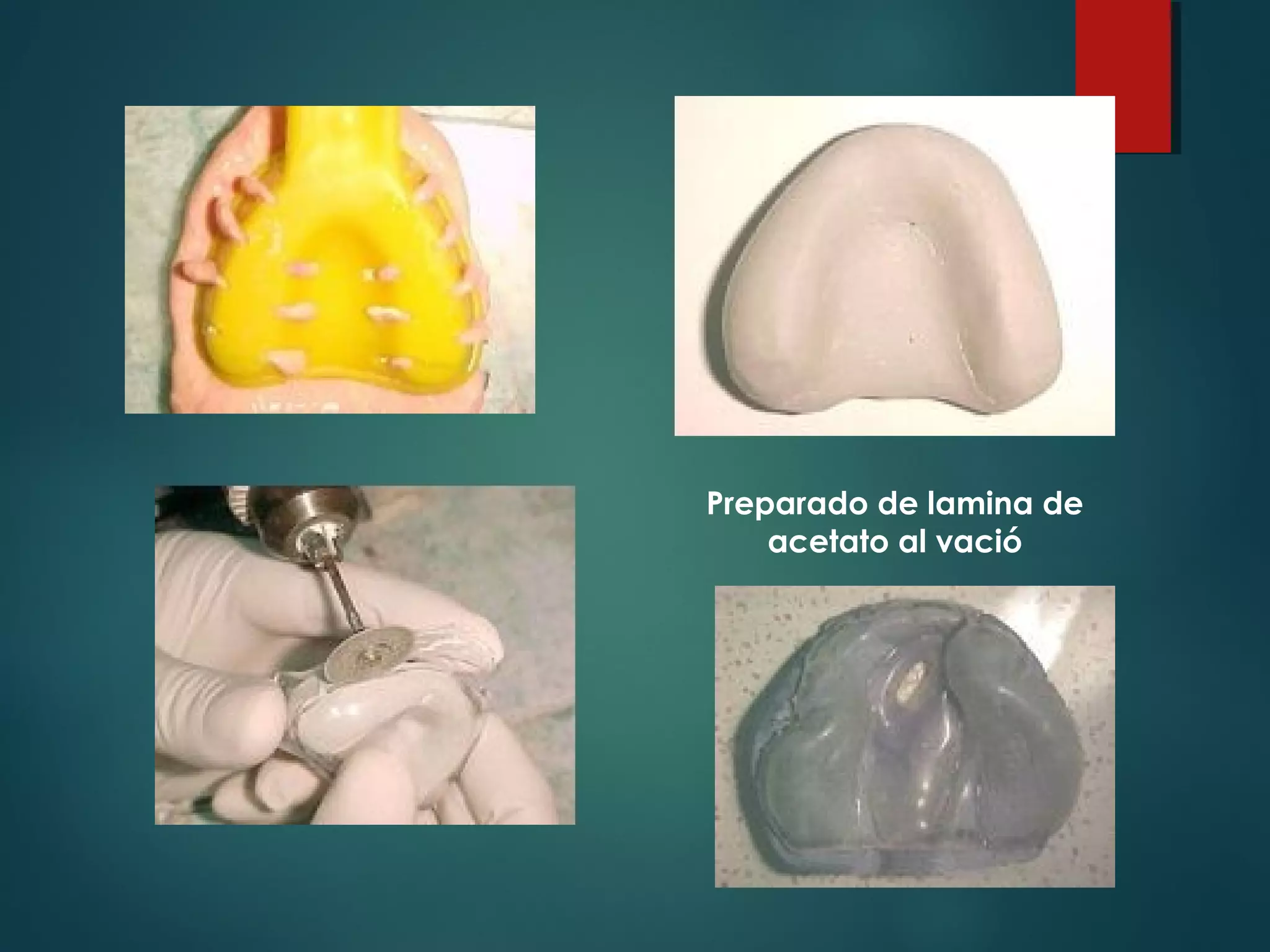 LABIO LEPORINO, FISURA DE PALADAR, TRATAMIENTO PRIMARIO | PPT