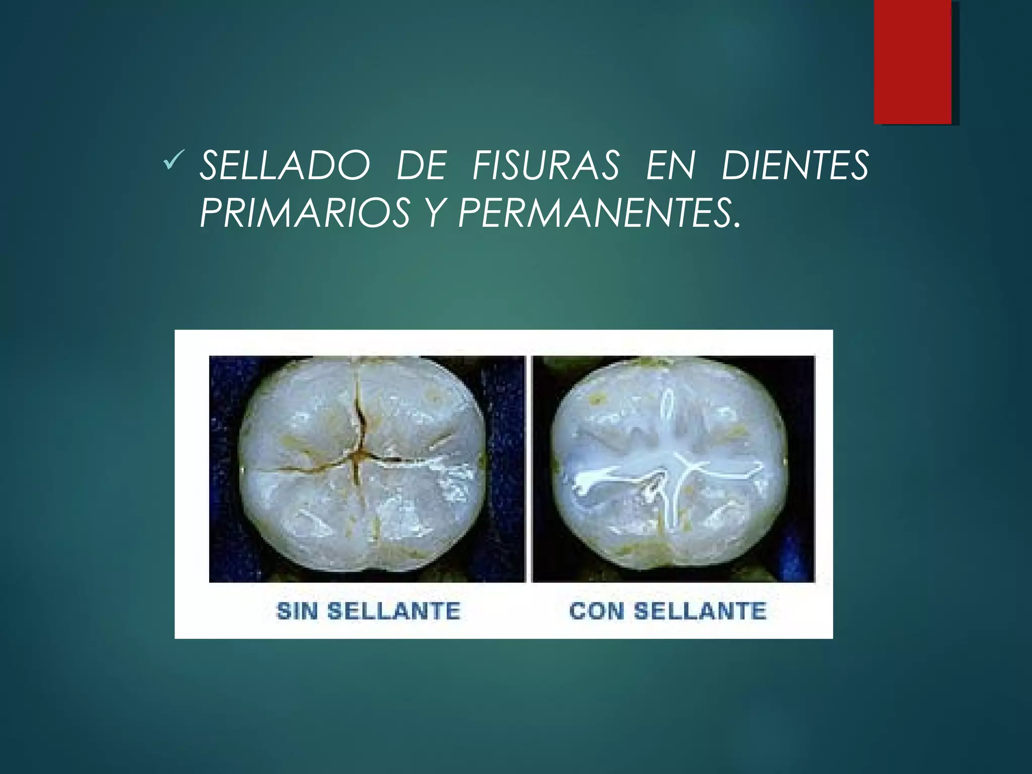 LABIO LEPORINO, FISURA DE PALADAR, TRATAMIENTO PRIMARIO | PPT