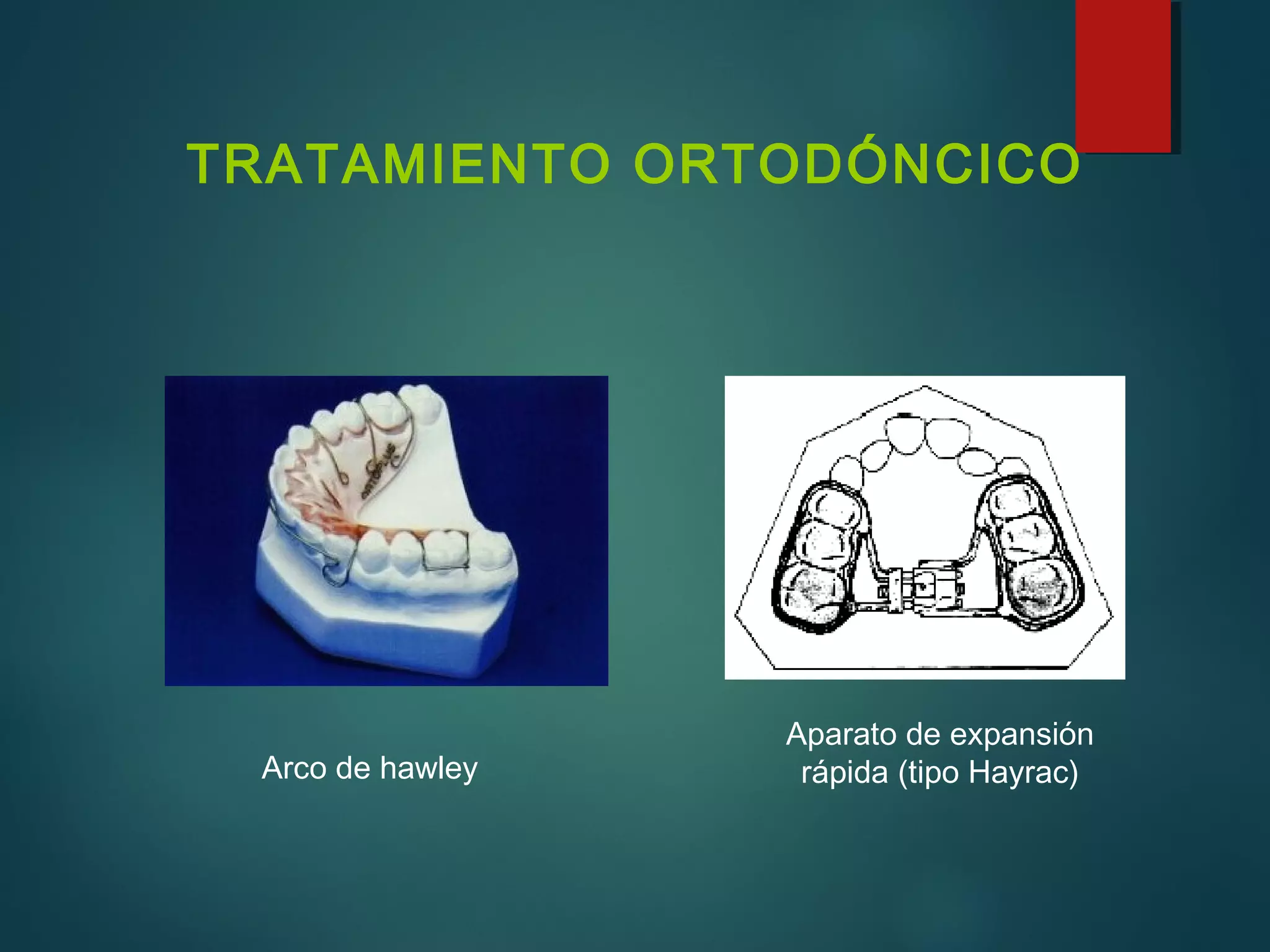 LABIO LEPORINO, FISURA DE PALADAR, TRATAMIENTO PRIMARIO | PPT
