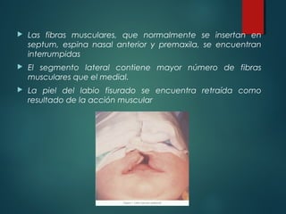 LABIO LEPORINO, FISURA DE PALADAR, TRATAMIENTO PRIMARIO | PPT