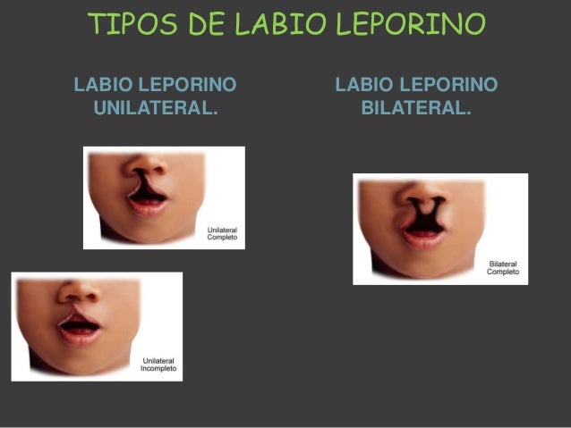 Labio leporino