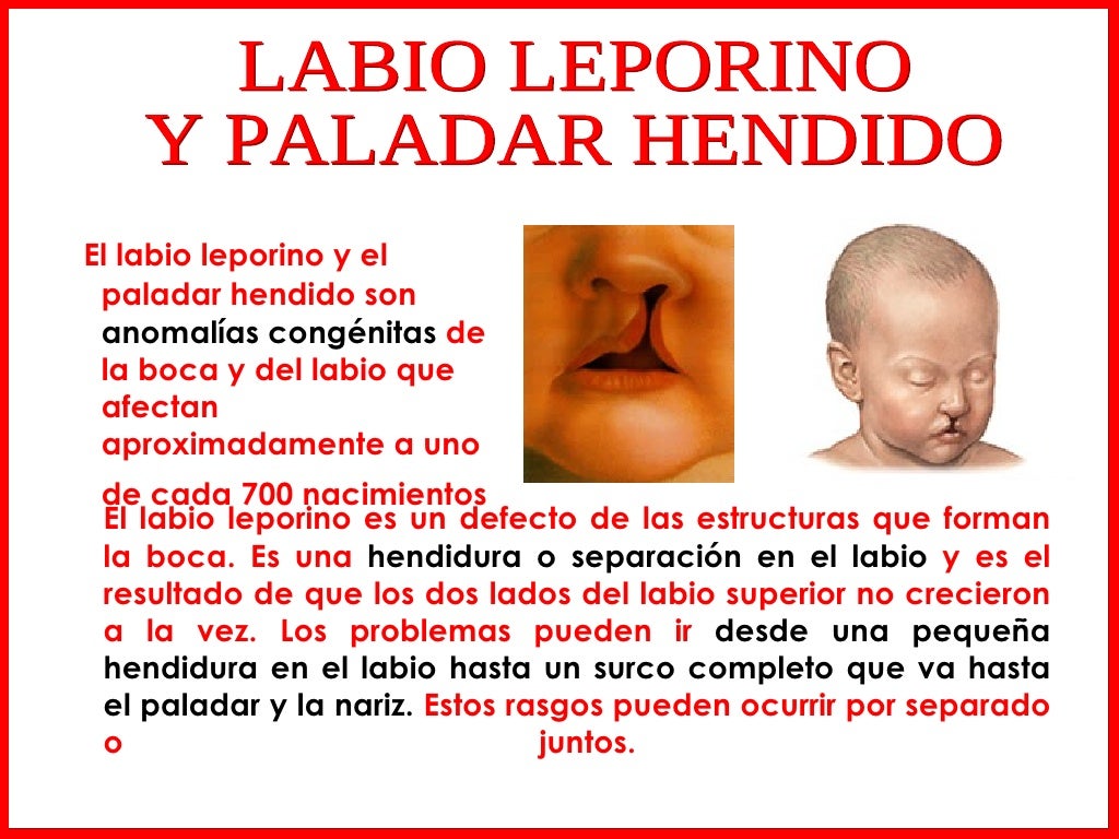 Labio Leporino Y Paladar Hendido
