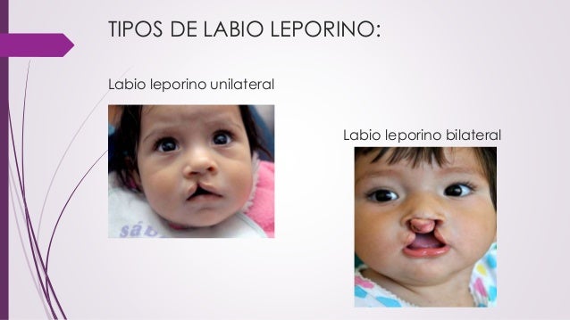 Labio leporino y paladar hendido