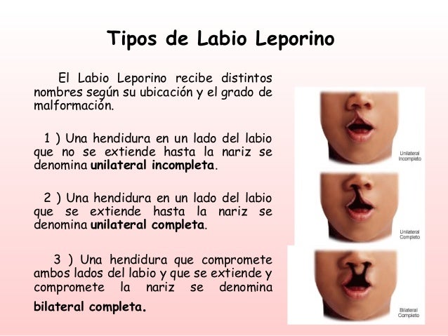 Labio leporino y paladar hendido