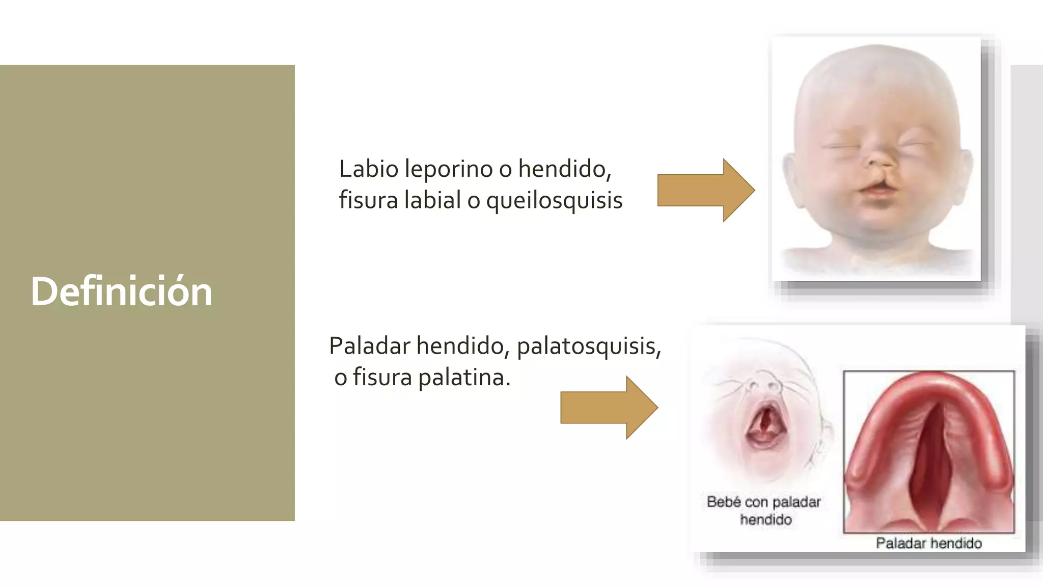 Labio leporino y paladar hendido en pediatría | PPTX