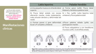 Labio leporino y paladar hendido en pediatría | PPTX