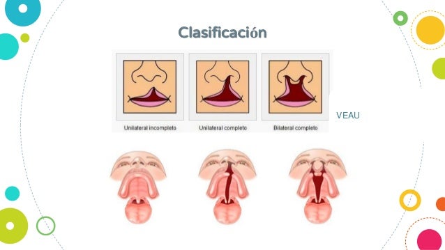 Labio paladar hendido