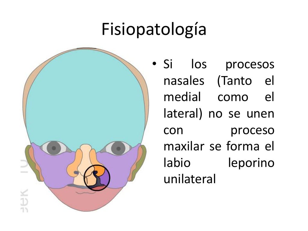 Labio paladar hendido