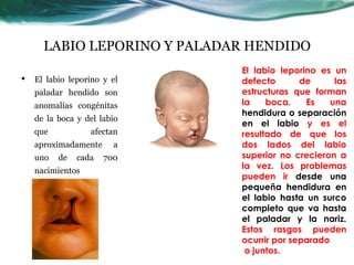 Labio y paladar hendido | PPTX