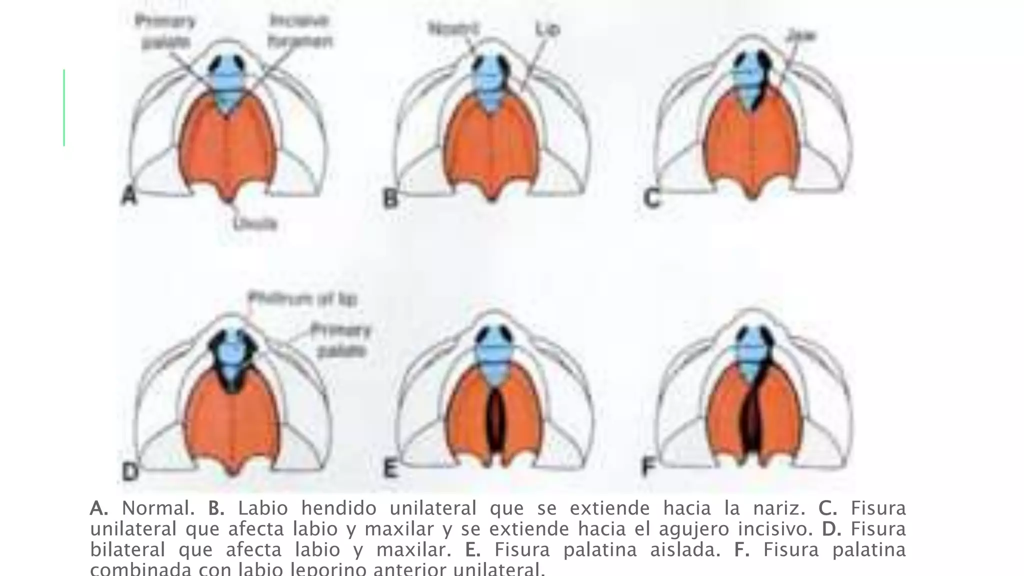 Labio y paladar hendido | PPTX | Ear, Nose and Throat Conditions ...