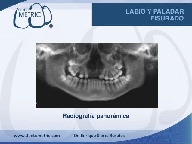 Labio y paladar fisurado