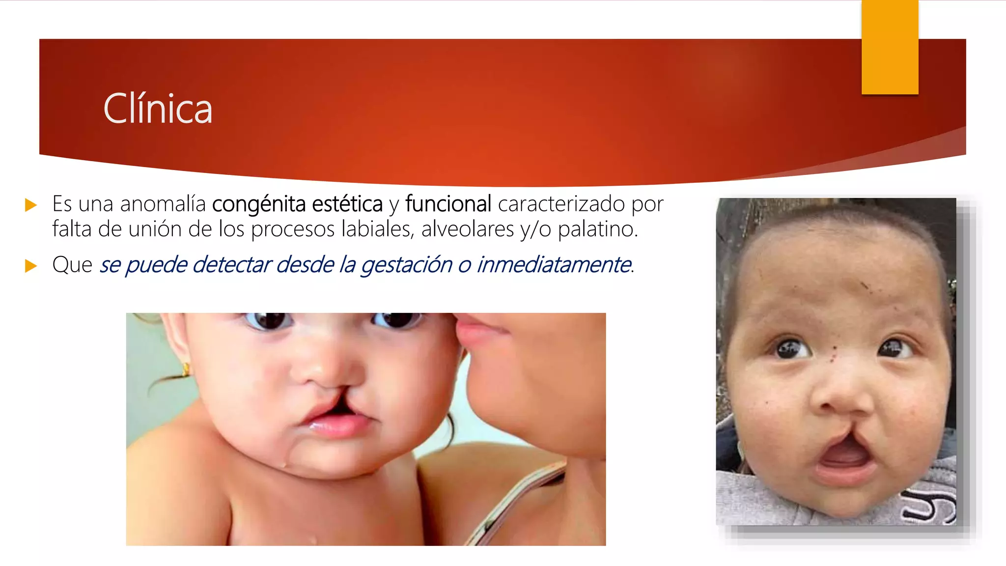 Labio y paladar hendido GENETICA CLINICA | PPTX